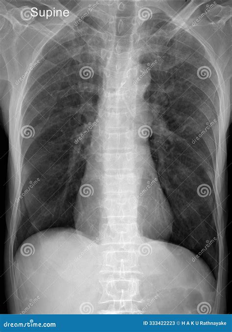 Cxr X Ray Chest X Ray A Radiographic Examination Used To Assess The