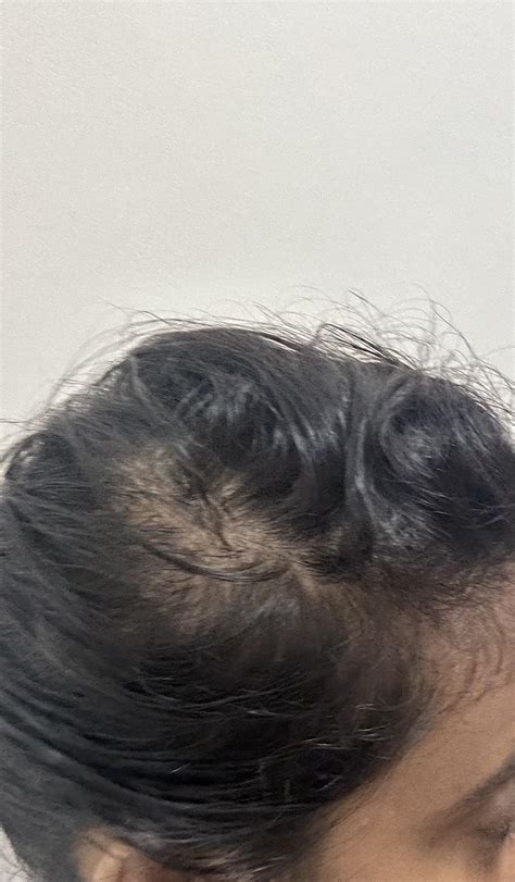 Going Bald R FemaleHairLoss