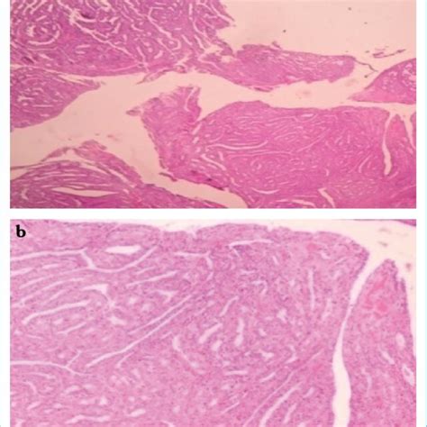 Pdf Hidradenoma Papilliferum Of The Vulva Is Histopathology Required