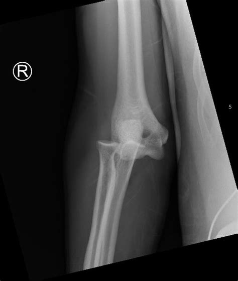 Critical Cases Elbow Dislocation Em Daily