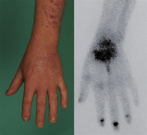 Hand With Plaque Type Psoriasis And Joint Swelling In The Wrist And In