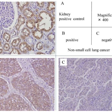 Expression Of Bmp 7 In Clinical Samples Immunohistochemical Staining