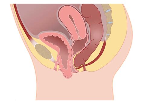 What Does A Prolapsed Urethra Look Like Iuqv