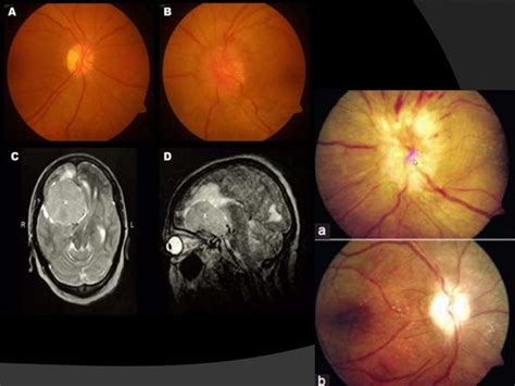 Optic Nerve Optic Atrophy Clinical Round Ppt