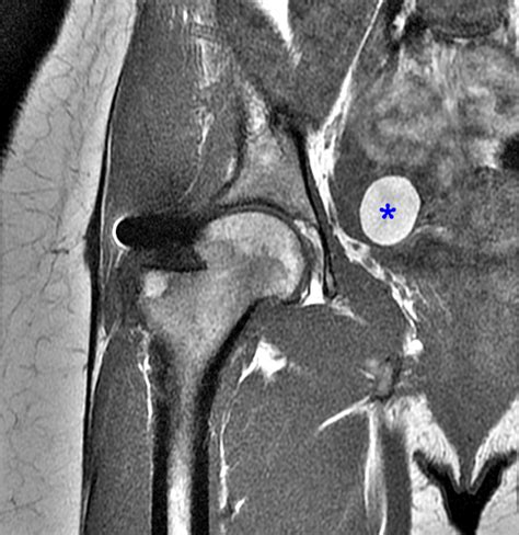 Gynecological Findings Encountered On Musculoskeletal Mri Radsource