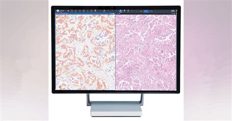 Roche Launches Digital Pathology Algorithm For Non Small Cell Lung