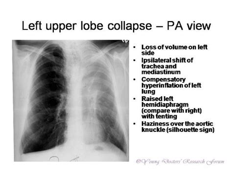 Collapse And Consolidation Lung Radiology