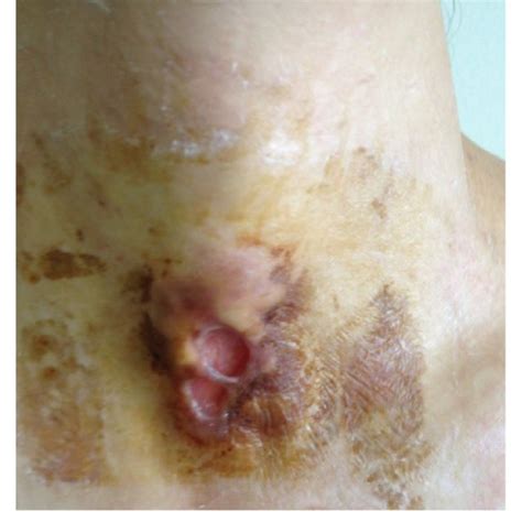 Scrofuloderma Tuberculosis Download Scientific Diagram