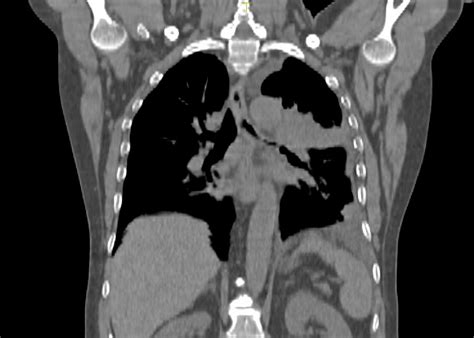 Cancerul Pulmonar Prezentare De Caz