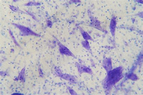 What Causes Hypoxic Ischemic Encephalopathy