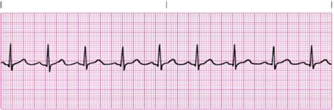 Abnormal EKG Flashcards Quizlet