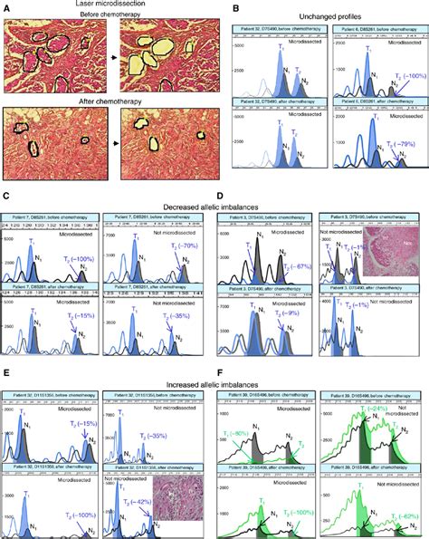 A Laser Microdissection Of Breast Carcinoma Paraffin Sections Stained