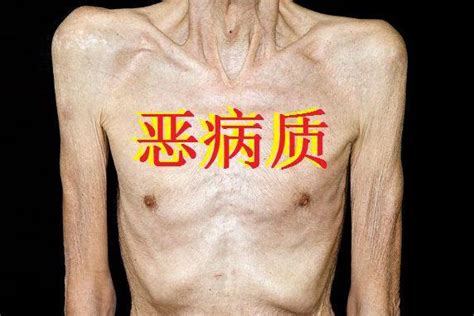 首个癌症恶病质药物adlumizanamorelin，阿纳莫林在日推出：有效增加体重肌肉质量食欲 知乎