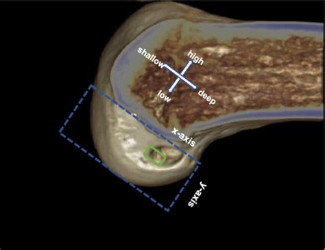 The Normal Range Of Positions Of Bone Tunnels At The Medial Wall Of The Download Scientific