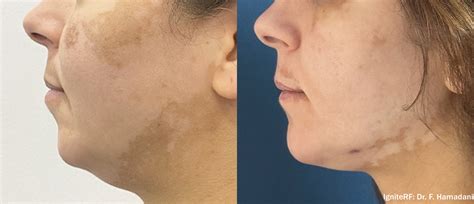 Laser Resurfacing And Skin Rejuvenation Co2 Ipl Rf Microneedling
