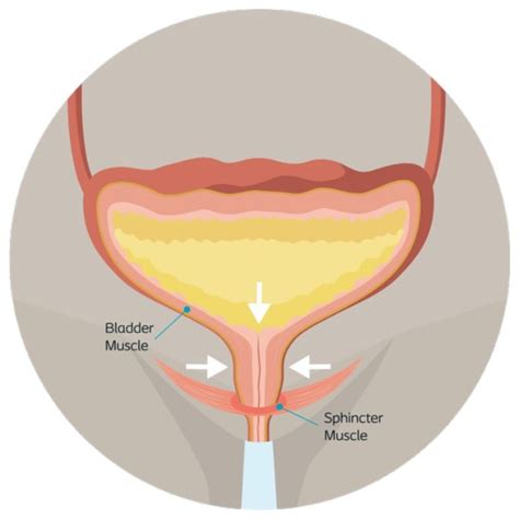 Types Of Urinary Incontinence Treatment Female Pelvic Solutions