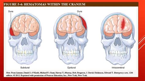 Nervous System Disorders Ppt Download
