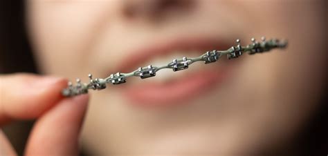 Power Chain Came Off Or Broke Diamond Braces