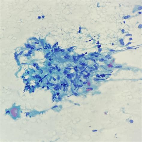 Thyroid Fna ~55yo F Ill Defined Hypoechogenic Region Rcytopathology