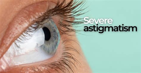 Corrective Options For Severe Astigmatism Ezontheeyes