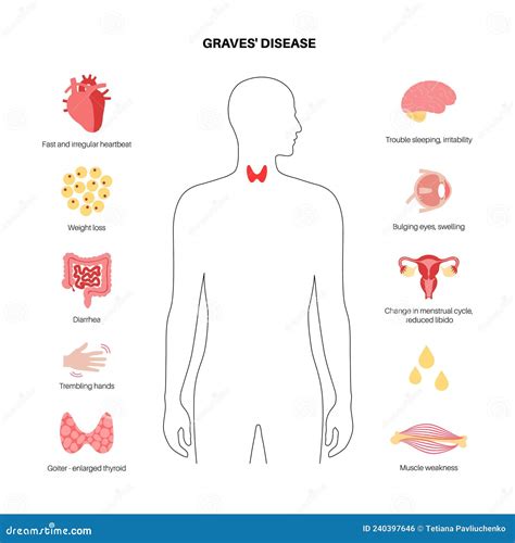 Hyperthyroidism Graves Disease Stock Illustration