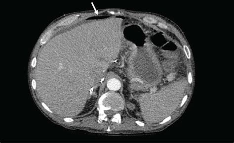 Axial Abdominal Ct Angiogram Showing Free Air In Peritoneal Cavity