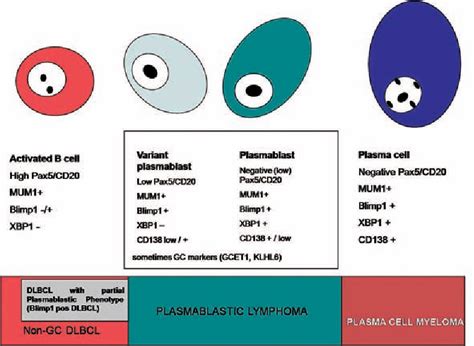 Figure 1 From Aggressive Large B Cell Lymphoma With Plasma Cell