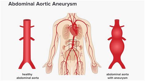 Aneurysm Types Symptoms And Causes Page 3 Entirely Health