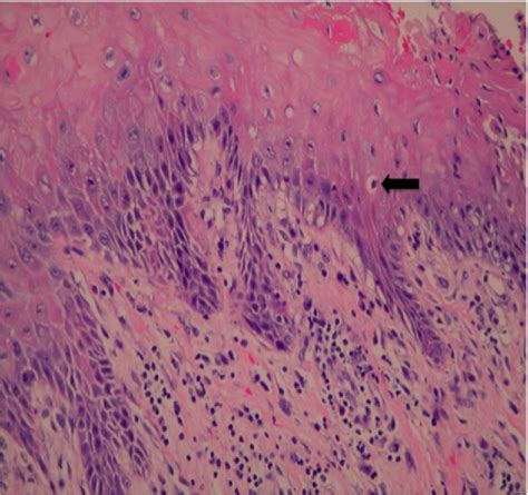 Figure 4 From Drug Induced Erythema Multiforme Major In An Elderly