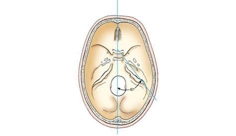 Dms Chapter Assessment Of Fetal Age And Size In The Second And