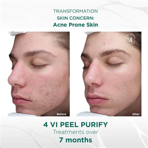 Effective Acne Treatments Clear Skin Solutions At Revive