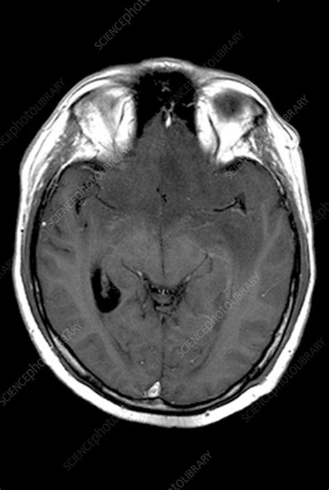 Coma Brain Dead Mri Scan Stock Image C0037254 Science Photo