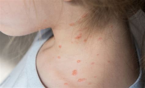 Ръст на случаите на скарлатина и варицела Cross Bg