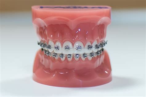 Train Track Braces Fixed Orthodontic Appliances 3dental In Dublin Limerick And Galway Near