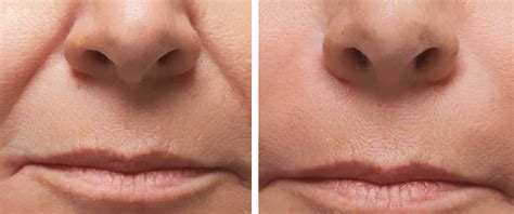 Injectare Acid Hialuronic Clinica Dr Cristina Bejan