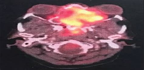 Reappraisal Of Swisnf Related Matrix Associated Actin Depen