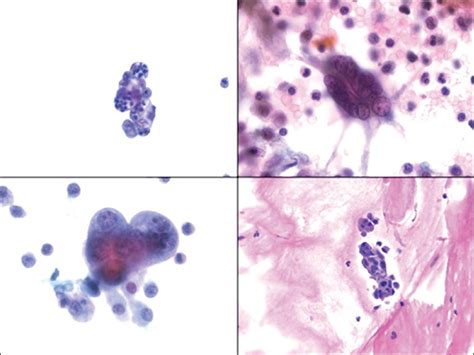 Abdominopelvic Washings A Comprehensive Review Cytojournal