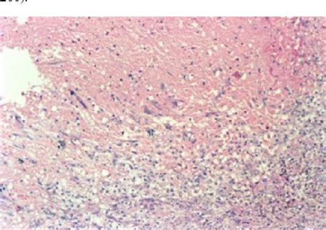 Figure 1 From Ischemic Fasciitis Unusual Location And Presentation
