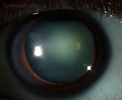 Nuclear Sclerotic Cataract