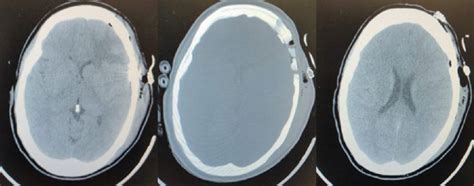 Brain Ct Scan After Surgery Status Post Left Frontal Craniotomy Good