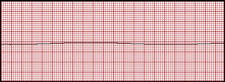 Section 9 Ventricular Rhythm