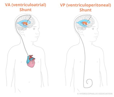 Hydrocephalus Shunt