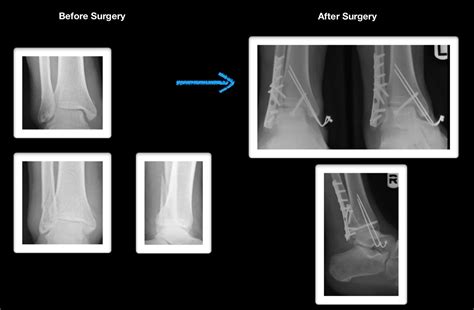 Trimalleolar Fractures Robert Sheinberg Dpm Weston Fl Podiatrist