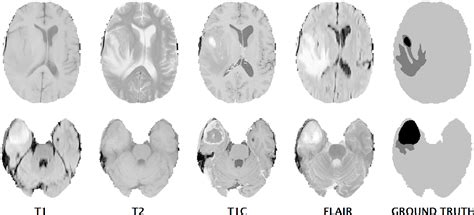 Figure 1 From Automatic Brain Tumor Segmentation In Multispectral MRI
