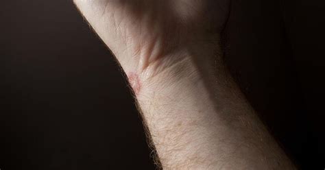 Ringworm Characteristics Causes And Prevention Easy Heal