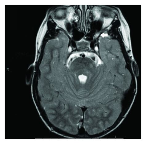 Brain Mri Axial Section T2 Showing Optic Nerve Glioma Download