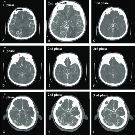 A I Multiphases Cta Brain In Three Patients 1st Row A B C 1st Case