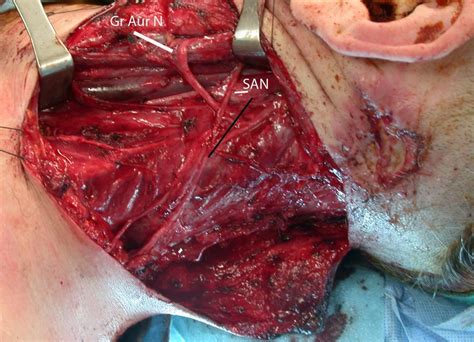 Posterolateral Neck Dissection Positioning And Surgical Steps Iowa