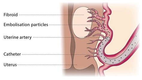 Californias Top Doctor For Uterine Artery Embolization Los Angeles Ca