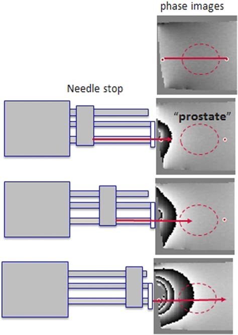 Measurements Of Magnetic Field Perturbation Due To The Implant Device